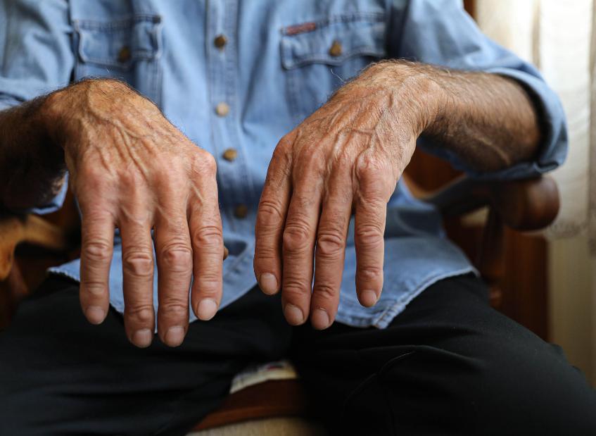 Discuss the treatment of increased muscle tension after spinal cord ...