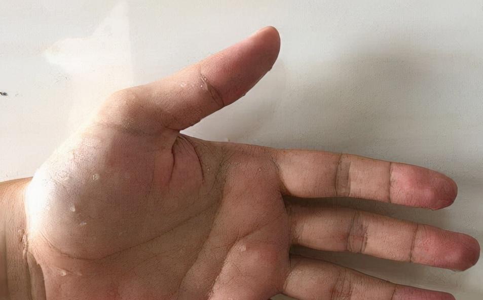 How does hidrosis affect people? - iNEWS