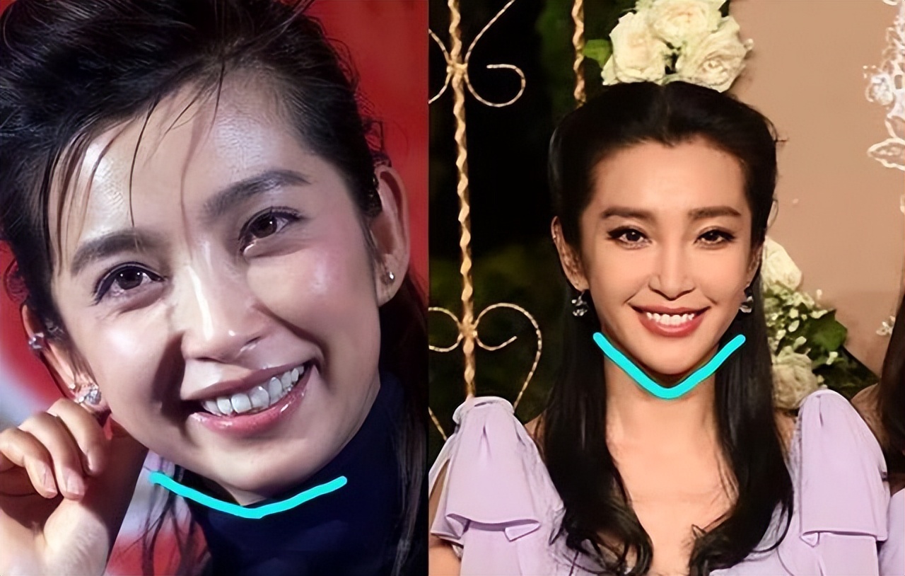 Is there any risk in bone reduction plastic surgery? Li Bingbing and ...
