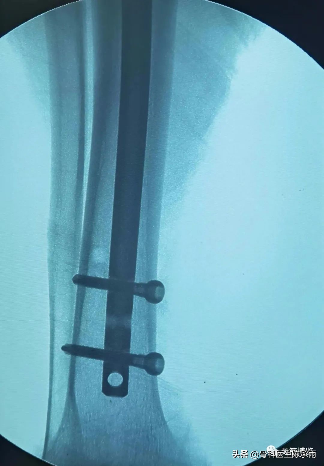 This week's tibial lock nails are available every day, seemingly simple ...