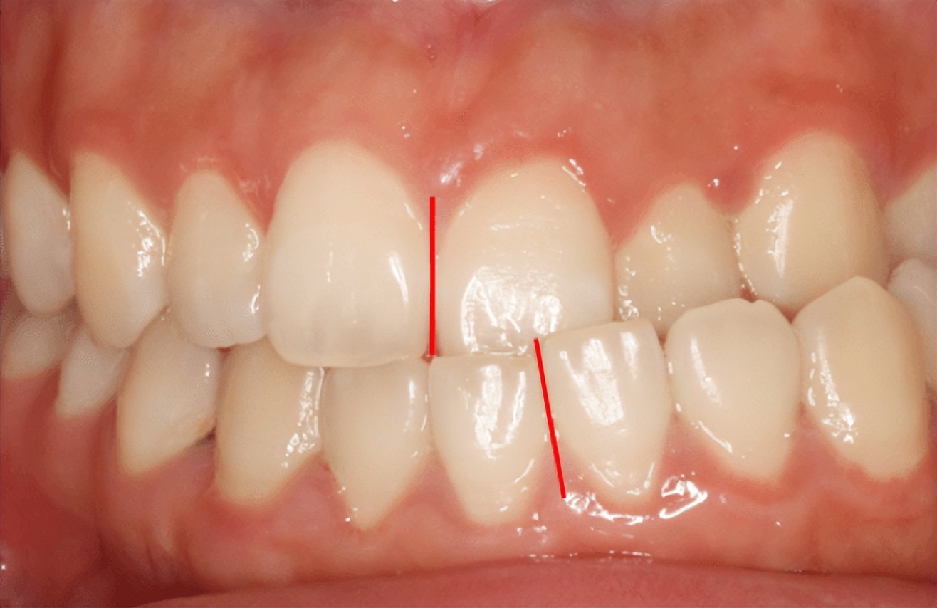 How should jaw deviation be treated? - iNEWS