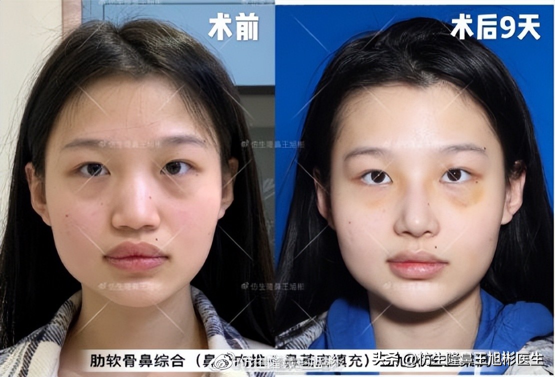 What are the factors that affect nasal alar hypertrophy?Can it be ...