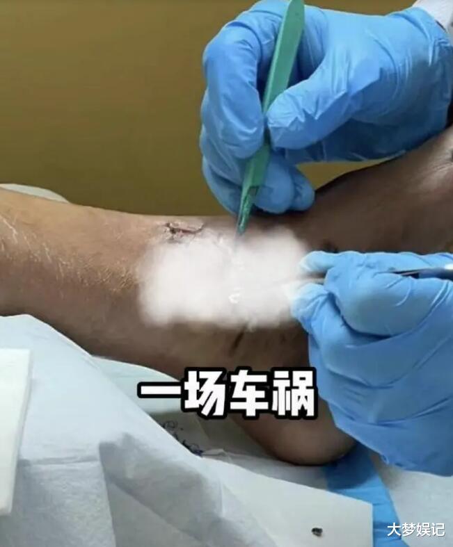 "Little Times" Chen Xuedong had a serious car accident! Stitches ...