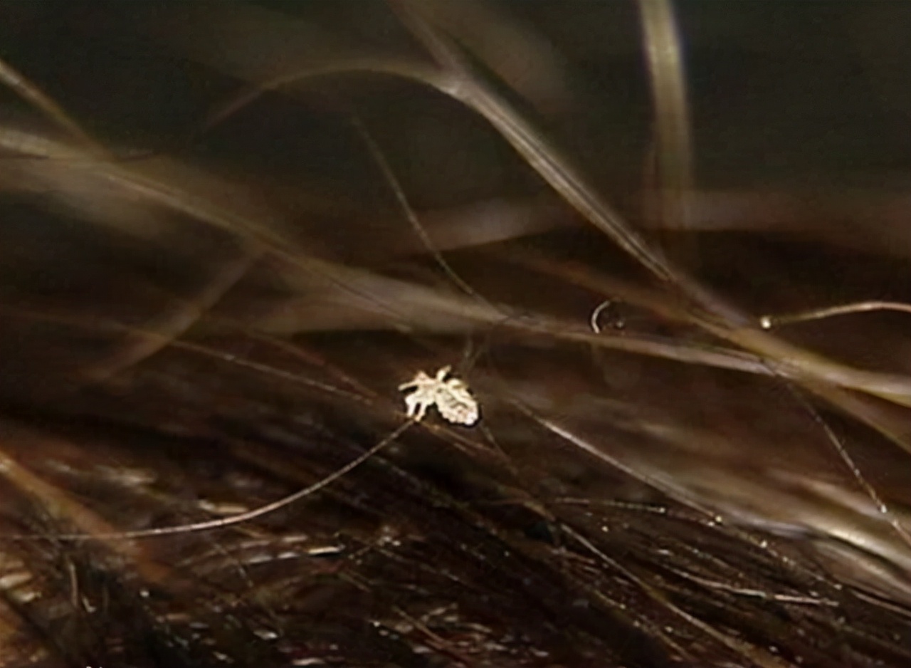 Thirty years ago, lice were common on the heads of men, women and ...