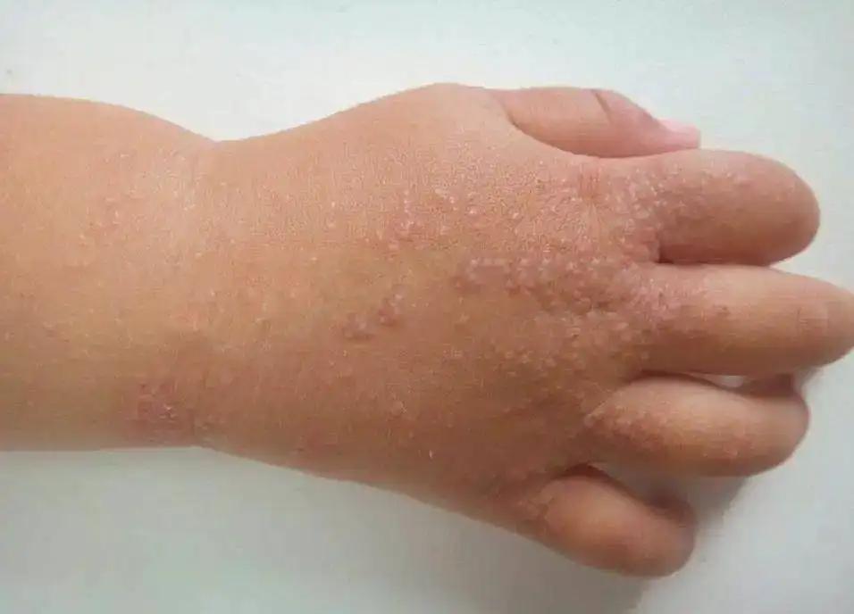 Pediatricians Say: Another Common Skin Inflammation in Children, Lichen ...
