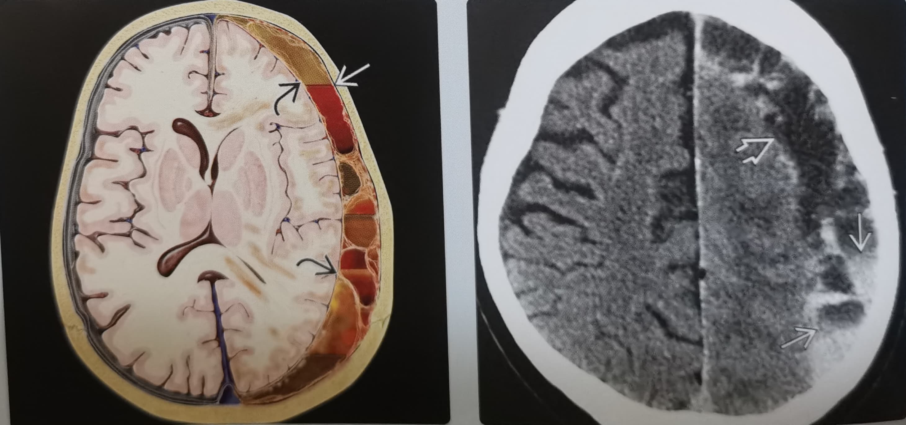 Subdural Hematoma—Key Points of Imaging Diagnosis and Classification ...