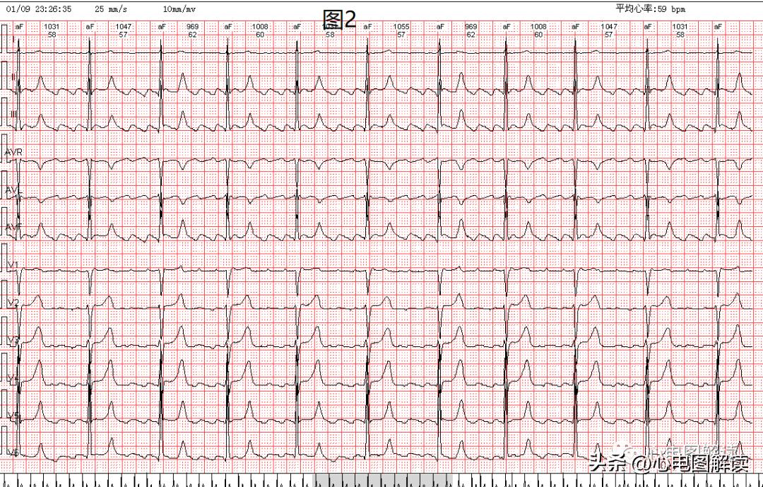 Atrial flutter - iNEWS