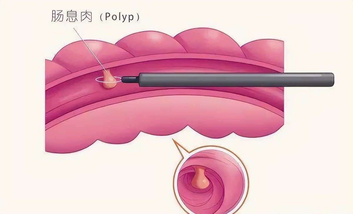 What are intestinal polyps?How does the body feel when polyps grow in ...