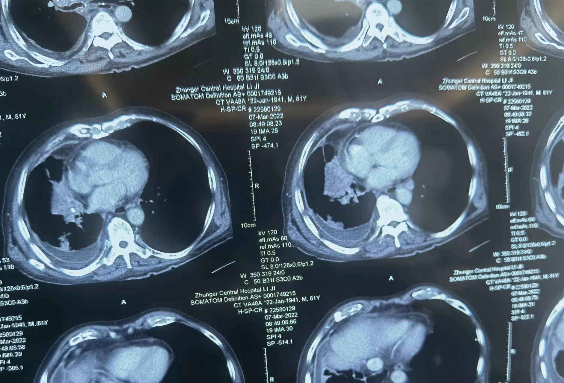 Advanced lung cancer is not terrible, the patient chooses this ...
