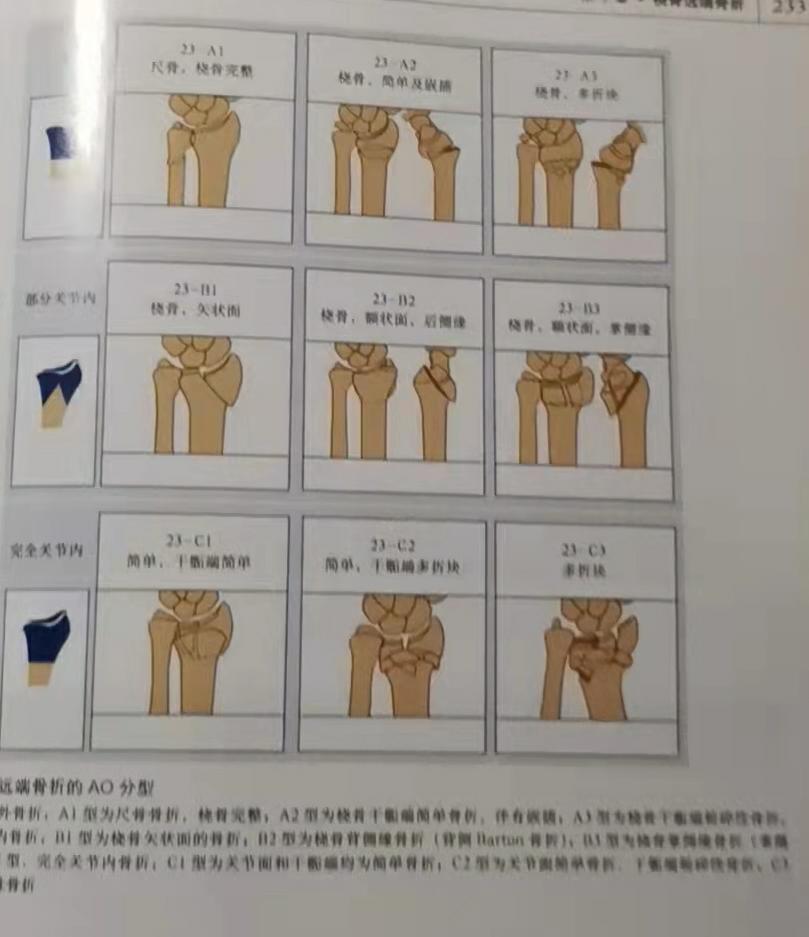 AO classification of distal radius fractures - iNEWS