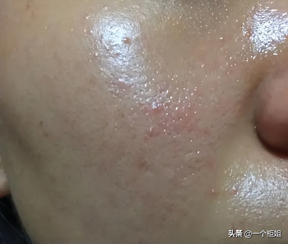 What looks like a white worm squeezed out of the nose pores, is it a ...