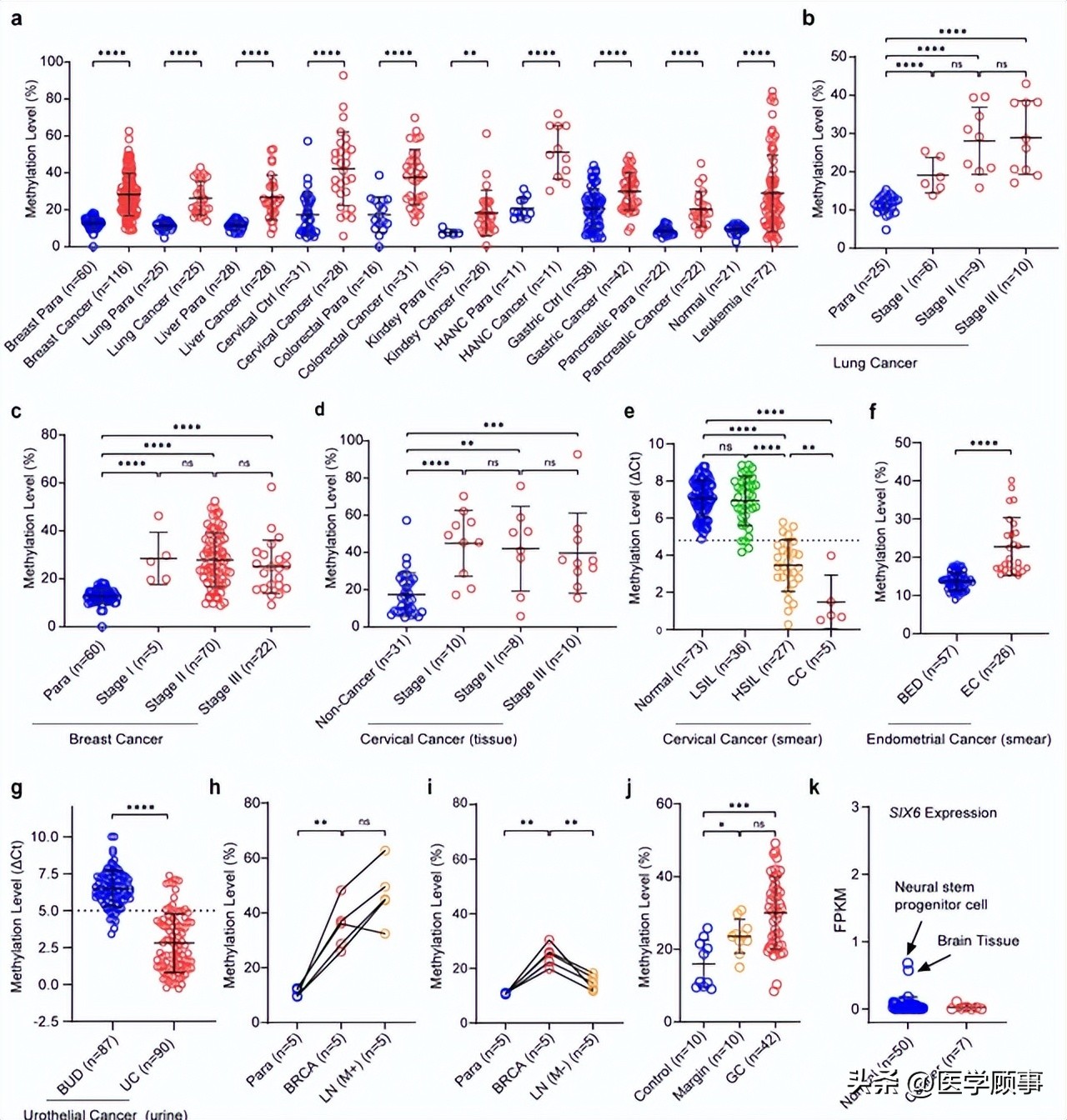 復旦於文強教授：發現全癌標誌物SIX6，各種癌症早篩查此一項即可 - 資訊咖