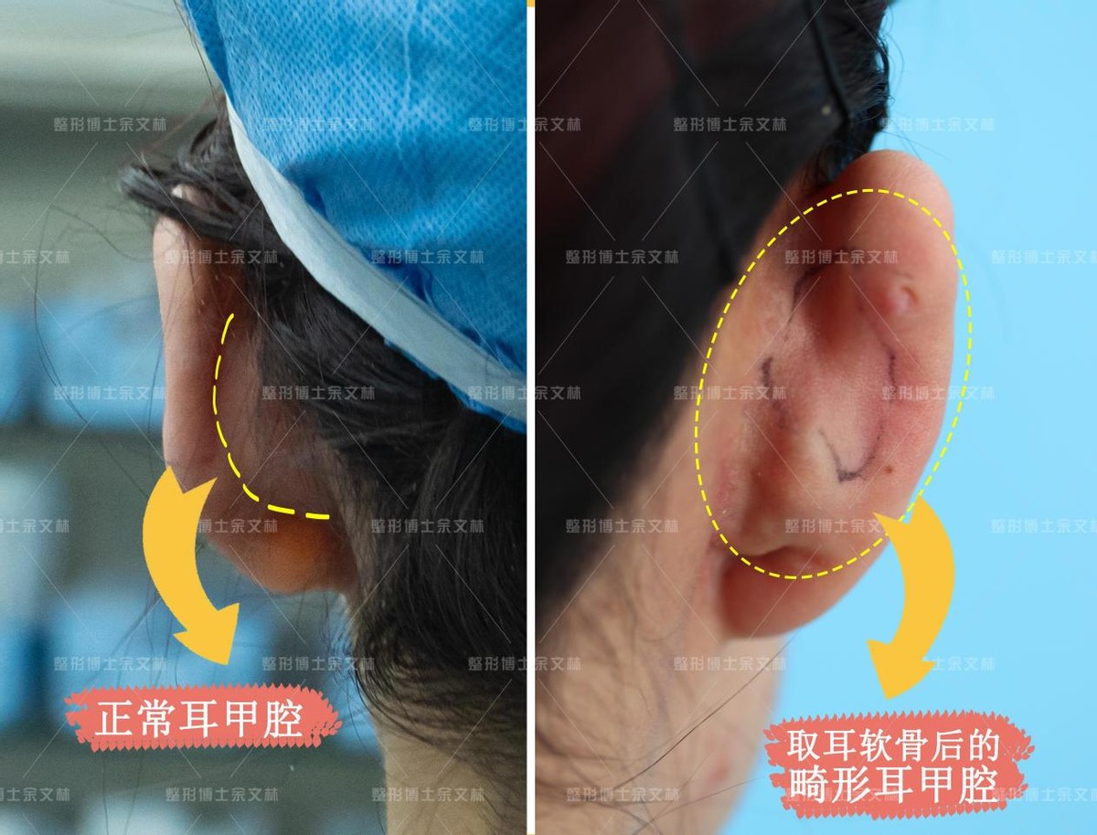 Will ear cartilage really collapse after rhinoplasty?it is true - iNEWS