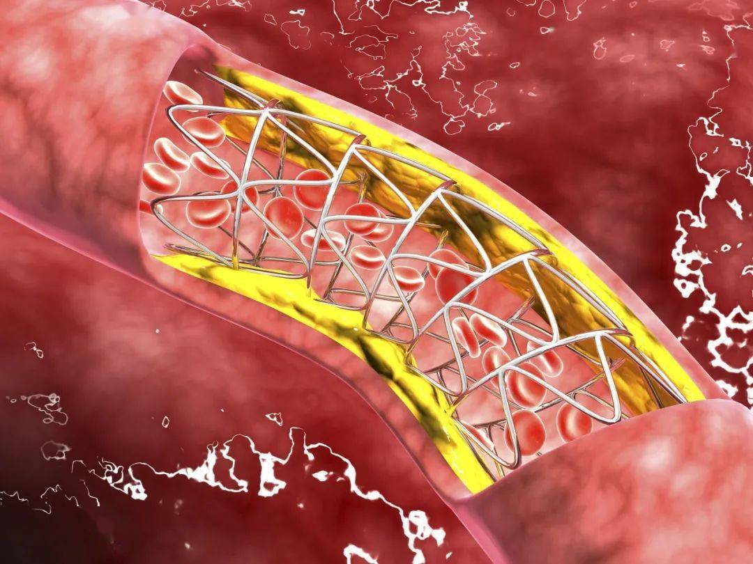 Is it necessary to install a stent for a heart attack? Not necessarily ...