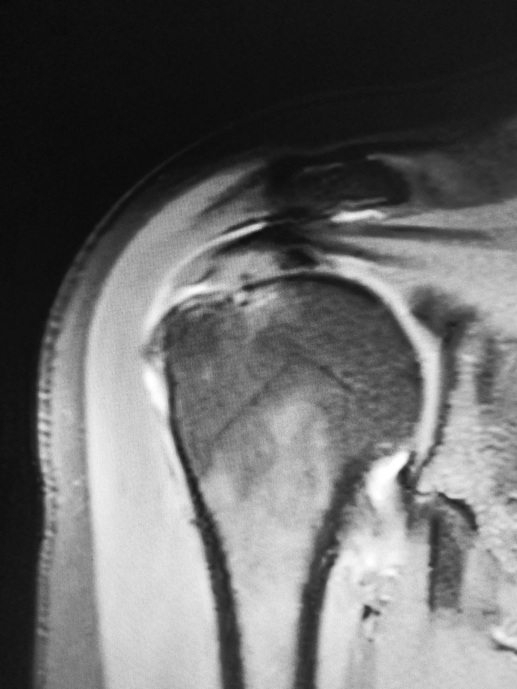 Shoulder pain must be frozen shoulder? ---Difference between frozen ...