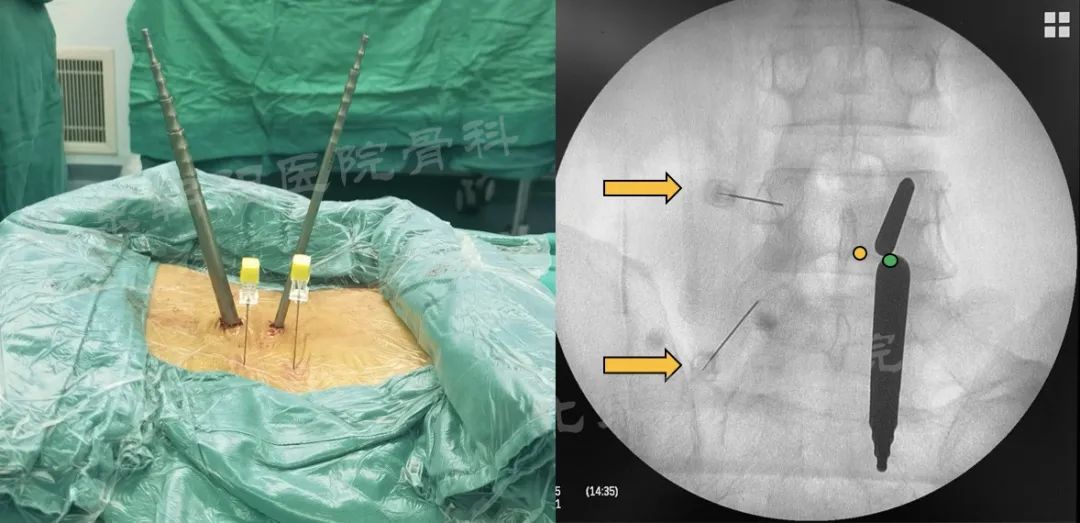20 cases of UBE surgery learning curve - iNEWS