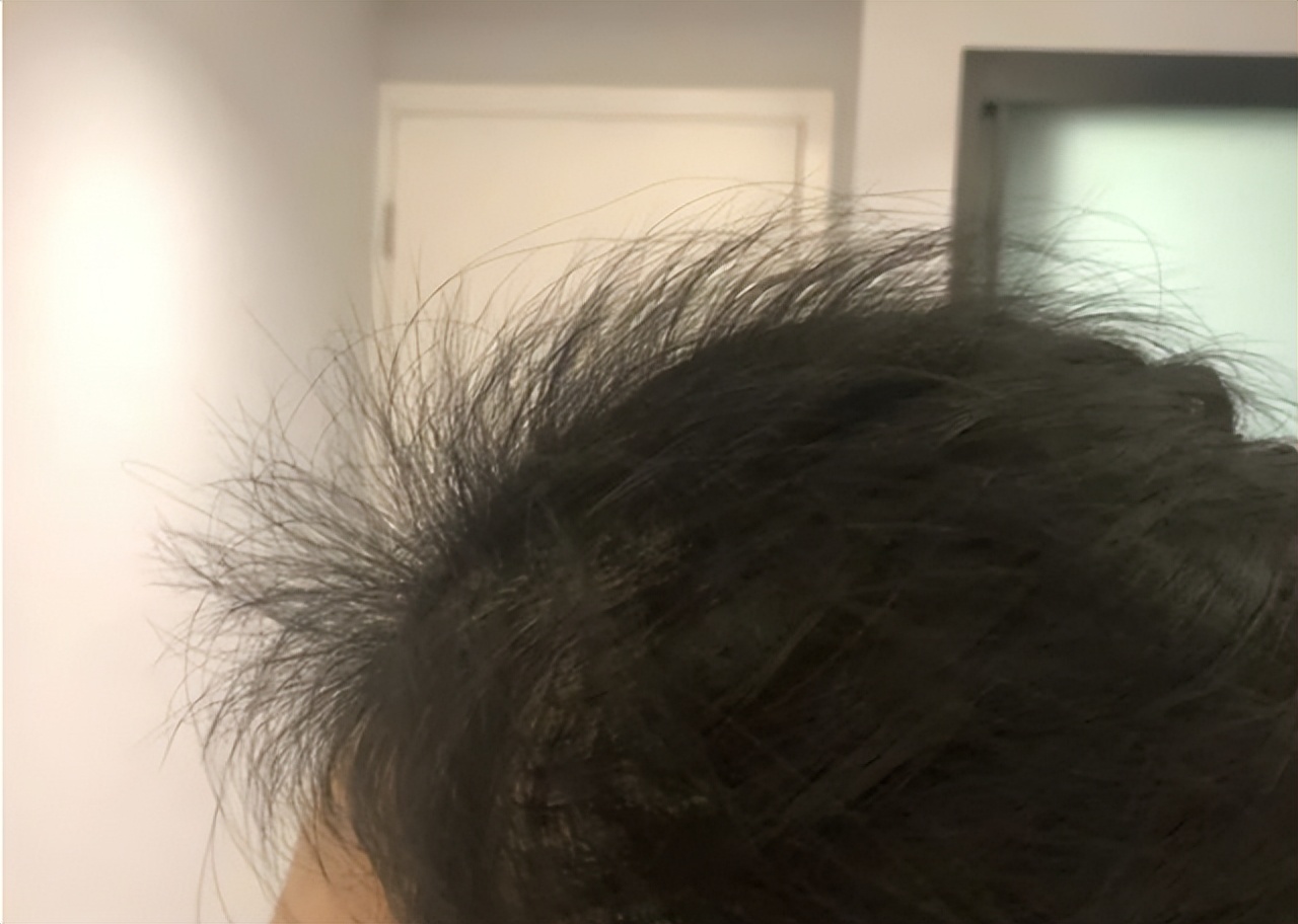 Treasure hair growth method has been discovered!There are 2 tricks to ...