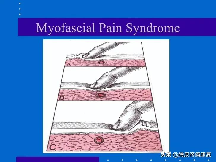 Summary of common soft tissue pain - iNEWS