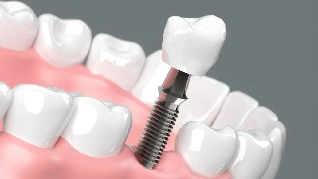 "A mouthful of teeth is equal to a BMW" has become a thing of the past ...