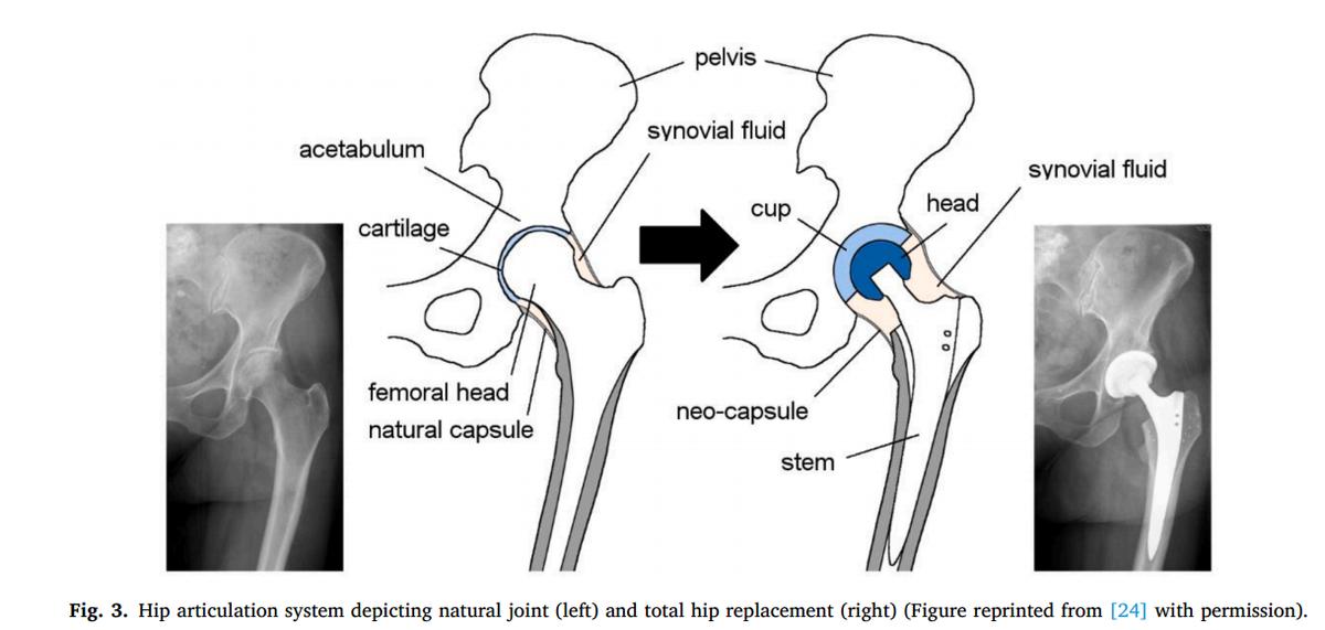 Research progress on multifunctional ceramic coatings in hip implants ...