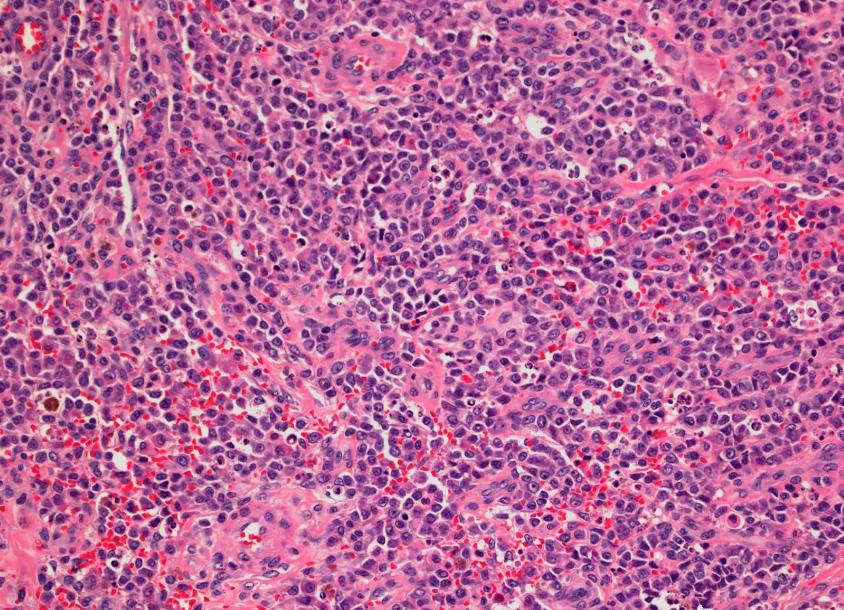 Leukemia, the incidence rate of men in the United States is higher than ...