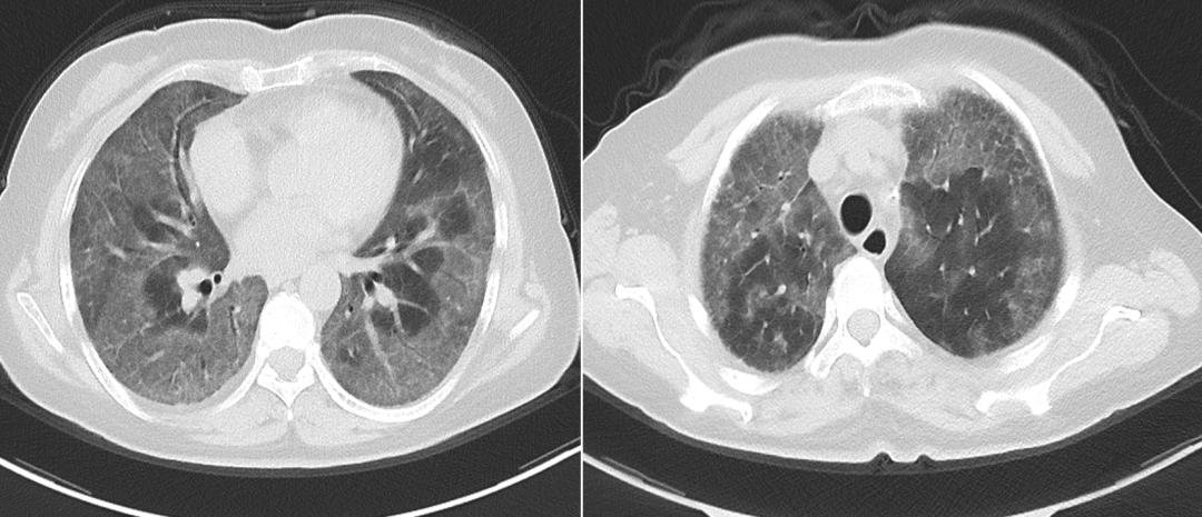 Diffuse ground-glass opacities in both lungs are still unresolved, and ...