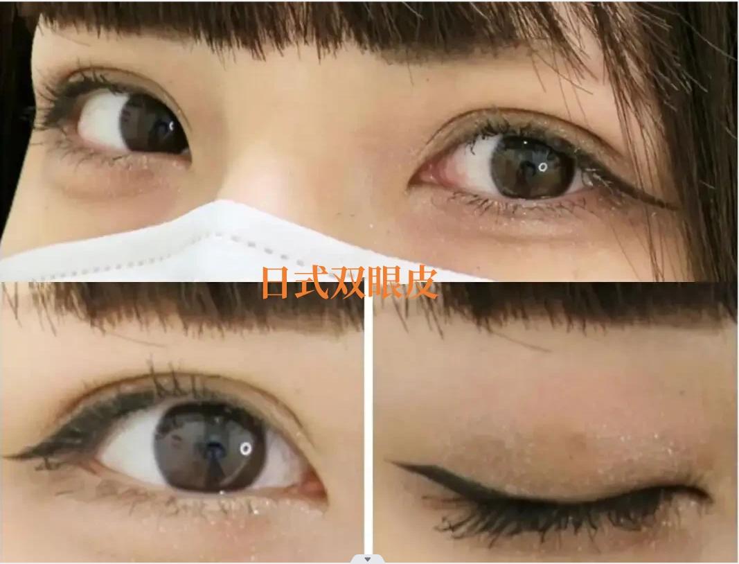 What is Japanese double eyelid - iNEWS