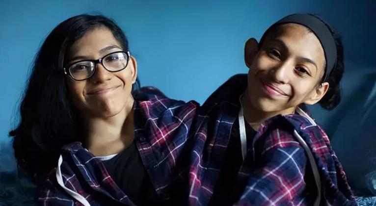 How do conjoined twins fall in love?A pair of conjoined twin sisters in ...