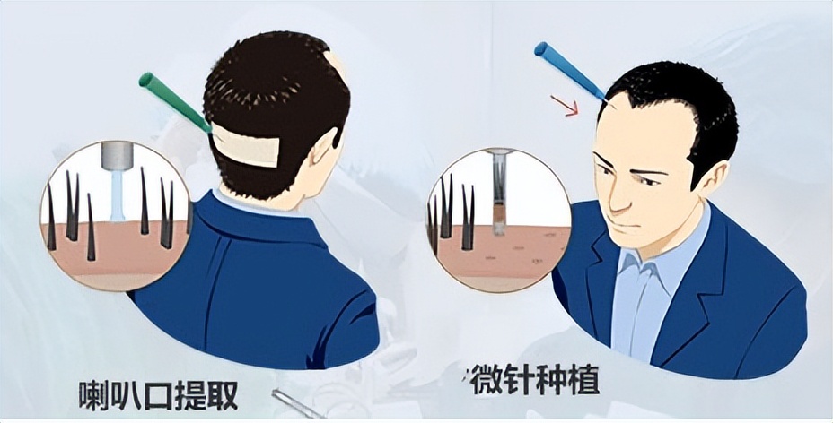 How to make hairline grow back? 14 hair care methods to help you remedy ...