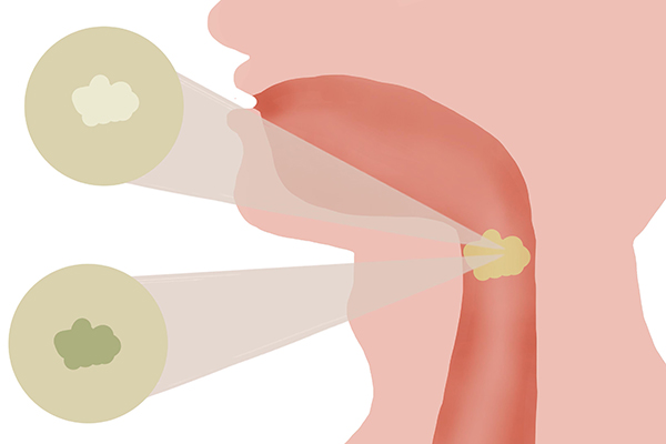 Phlegm is the "barometer" of lung health. What do the 5 "red, yellow ...