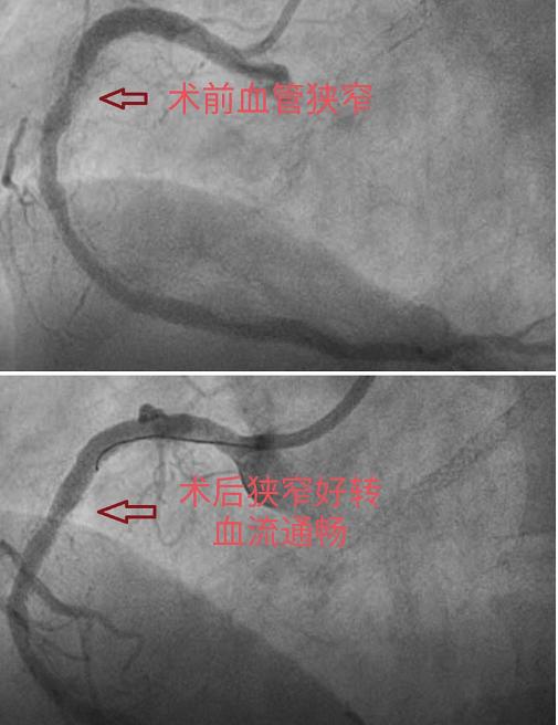 Shock wave balloon technology "beats the cow across the mountain" to ...