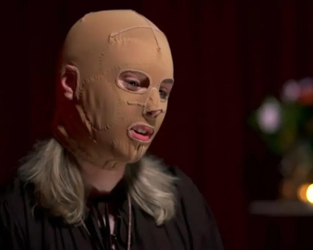The woman who survived the volcanic eruption survived, 70% burned, and ...