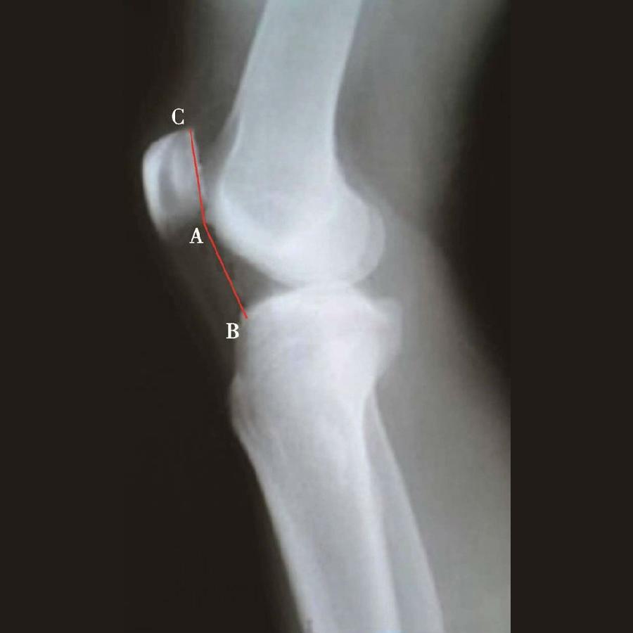 Radiographic evaluation of patellar height and patellar trochlear - iNEWS