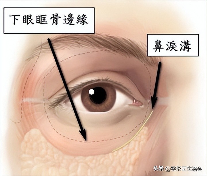 40-50 years old have deep tear grooves, what should I do? The doctor ...