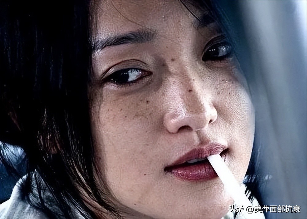 How do freckles form, and how can they be removed safely? - iMedia