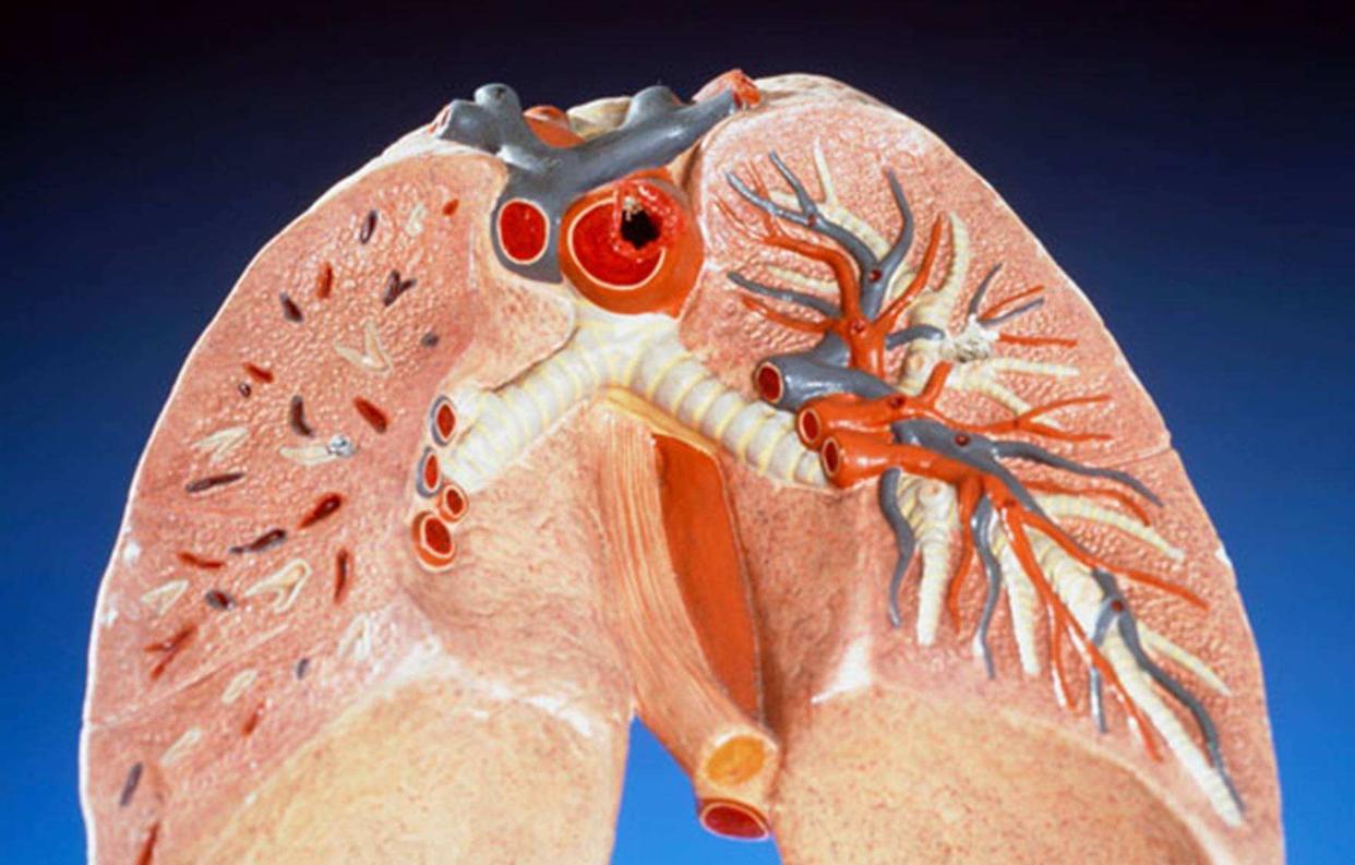 Phlegm is a signal of lung health. What do coughing up black phlegm ...