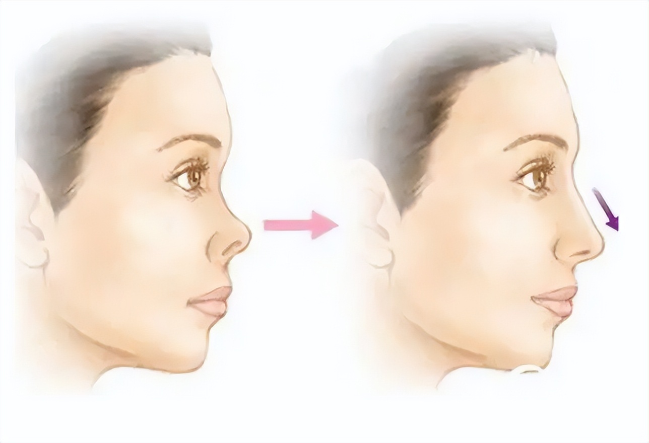 What is the cause of exposed nostrils and how to improve it? - iNEWS