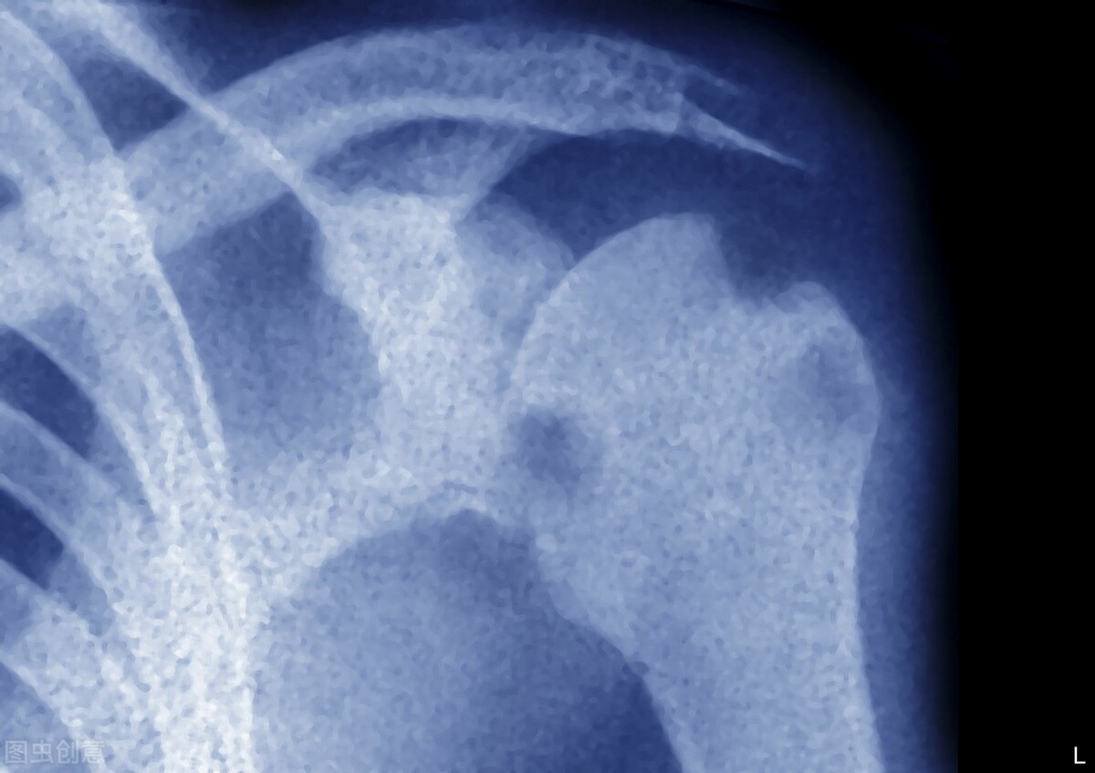 What are the diagnostic points of bone and joint tuberculosis?Which ...