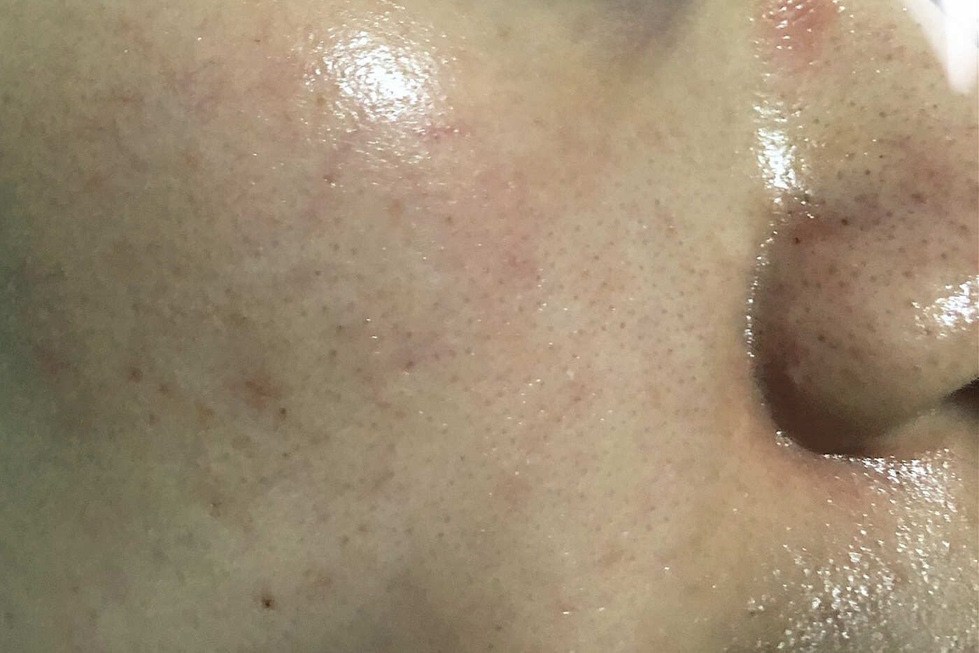 White strips can be squeezed out of the pores of the nose, what is it ...