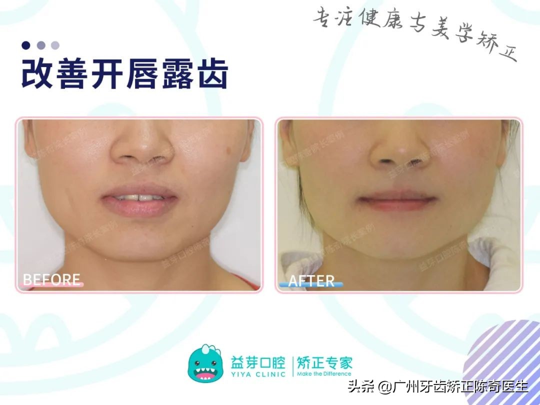Super-difficult bony protrusion, can the chin be corrected in an older ...