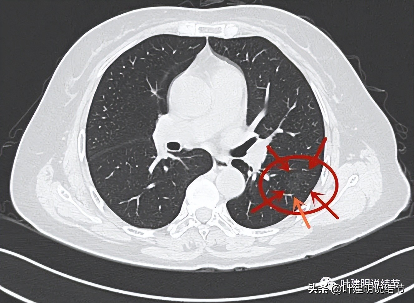 Rare: PET-CT and enhanced CT are useless for such a huge lesion in the ...