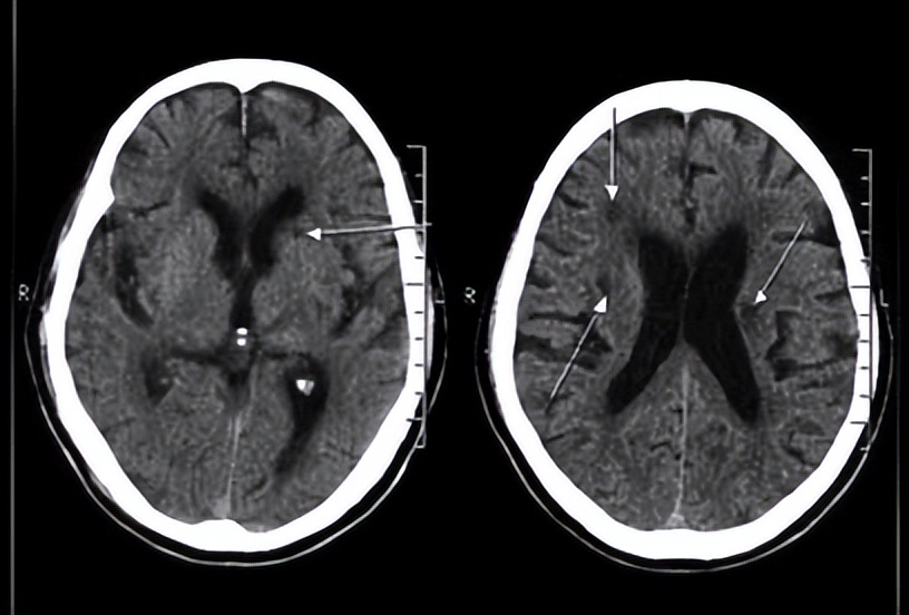 To prevent the recurrence of cerebral infarction, three persistence is ...