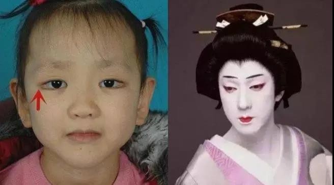 Kabuki Syndrome: Beautiful is also a disease, this disease can not be ...