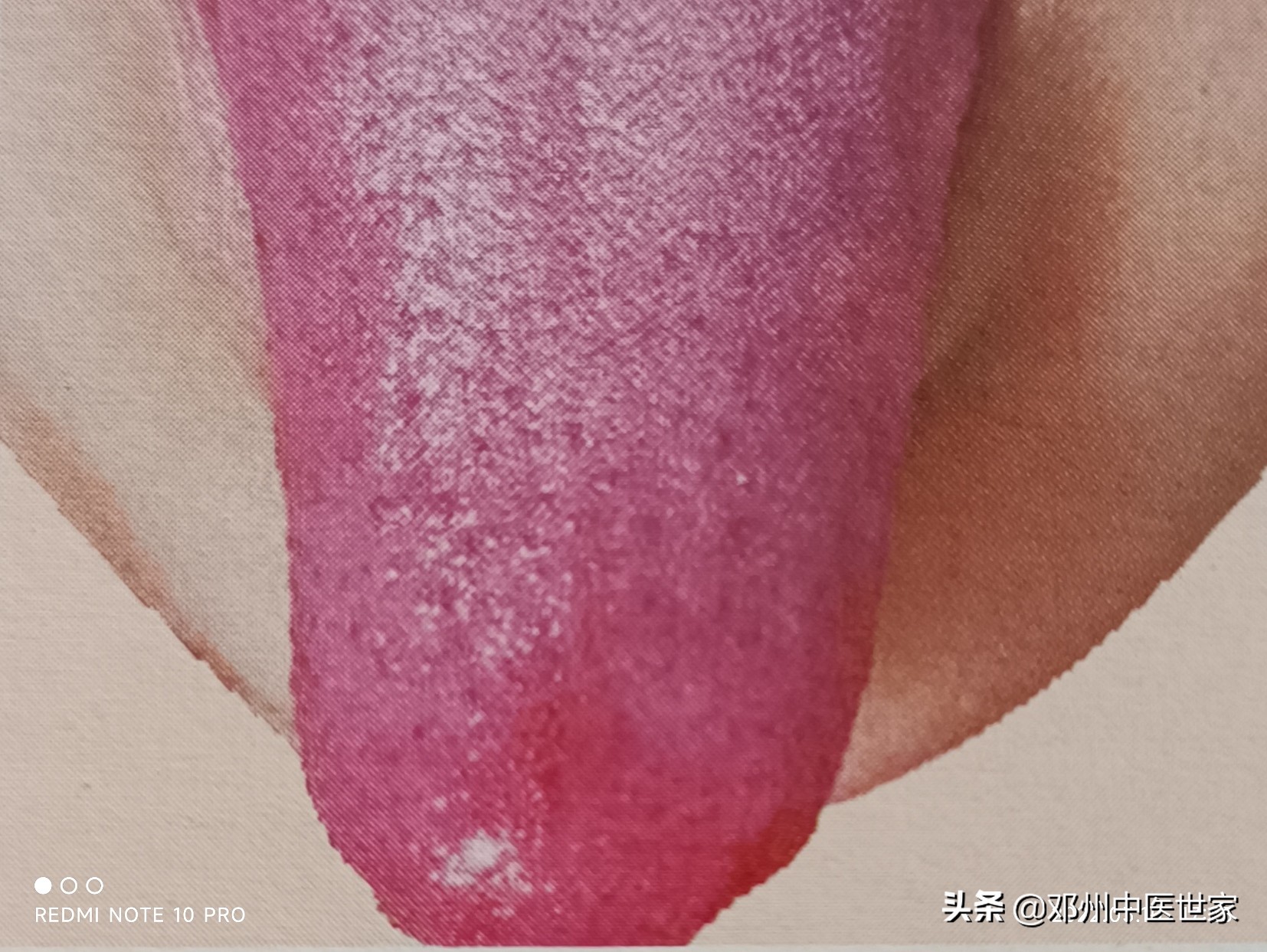 Lung carbuncle, tongue sign during recovery - iNEWS