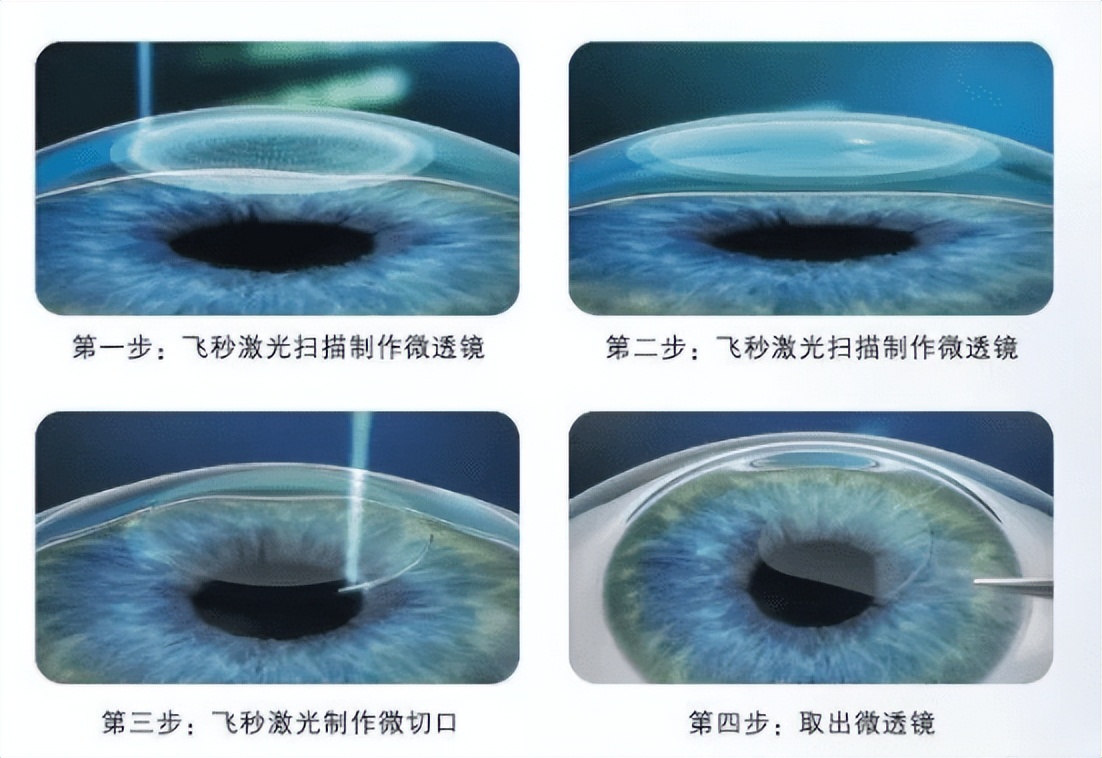 How to choose myopia surgery?Super detailed comparison of the four ...