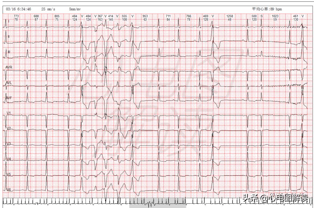 Multifocal ventricular tachycardia? - iNEWS