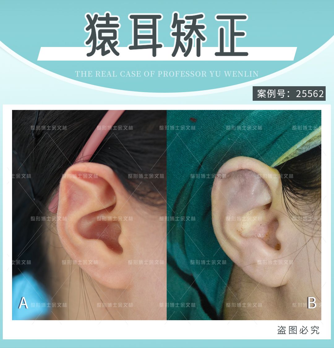 Are "popular" ape ears attracting wind?What is the difference between ...