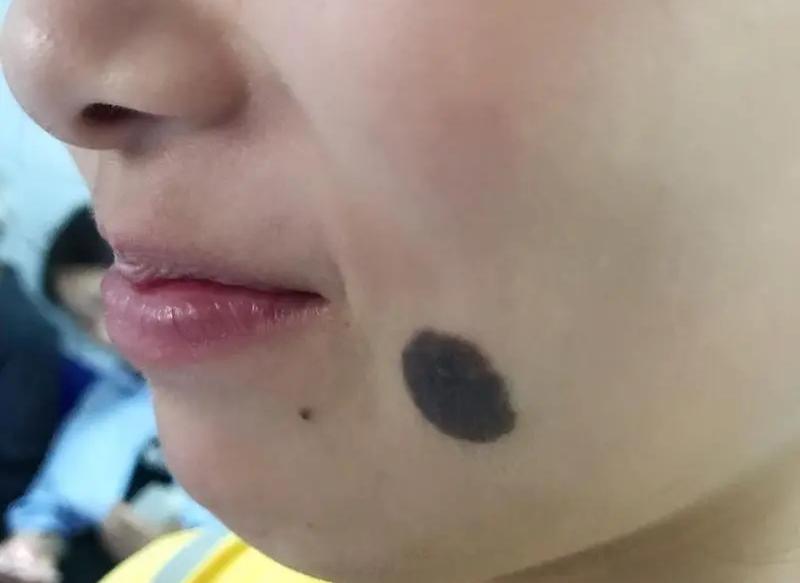 Beware of black hairy moles, beware of malignant transformation - iNEWS