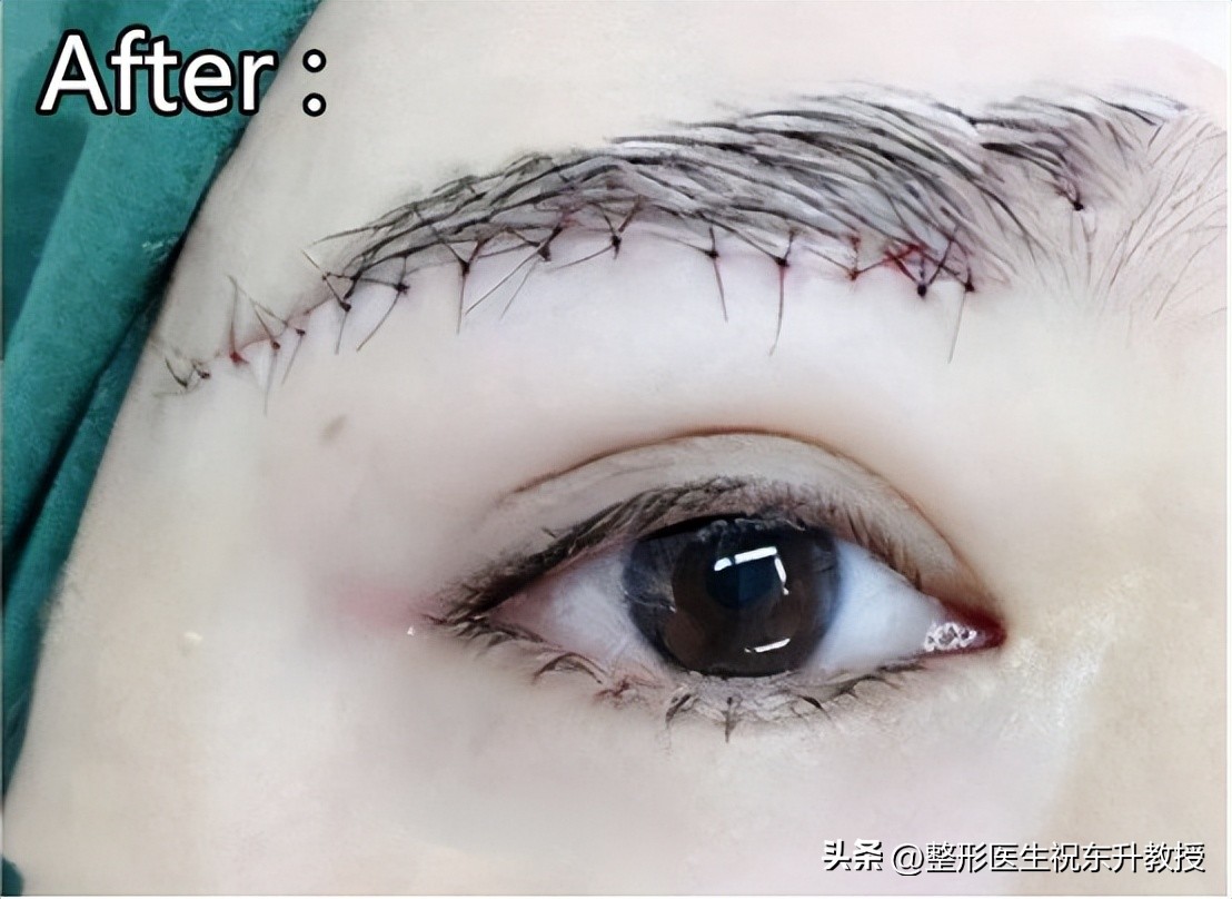 It took more than an hour to do the eyebrow lifting operation, the real ...