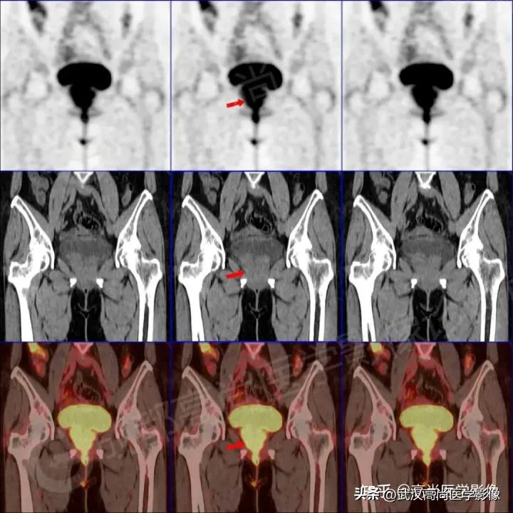 One case of urethral leiomyosarcoma diagnosed by PET/CT "Wuhan Noble ...